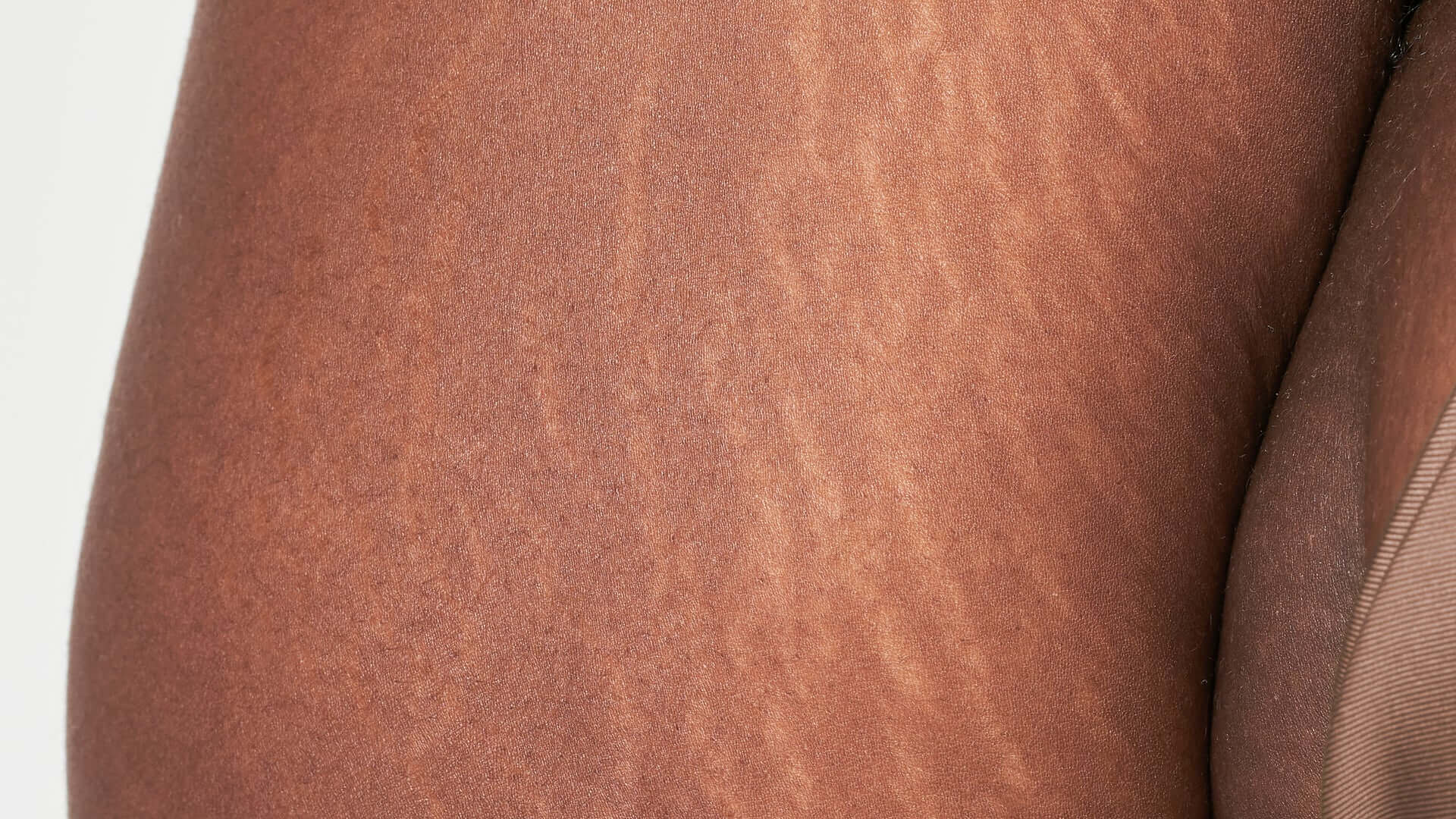 Estria em homem: causas, tratamentos e formas de prevenção